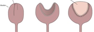 Augmentation Bladder – Ileocystoplasty – Dr. Jo Schoeman
